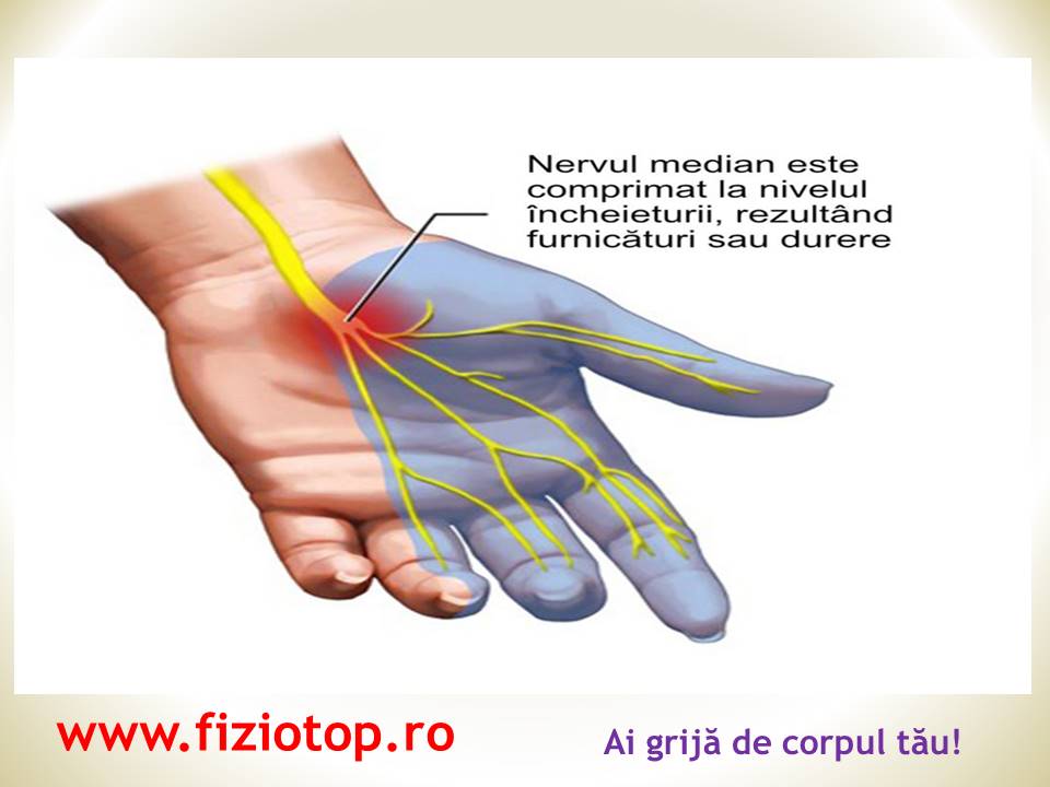 Sindromul de tunel carpian - Fiziotop