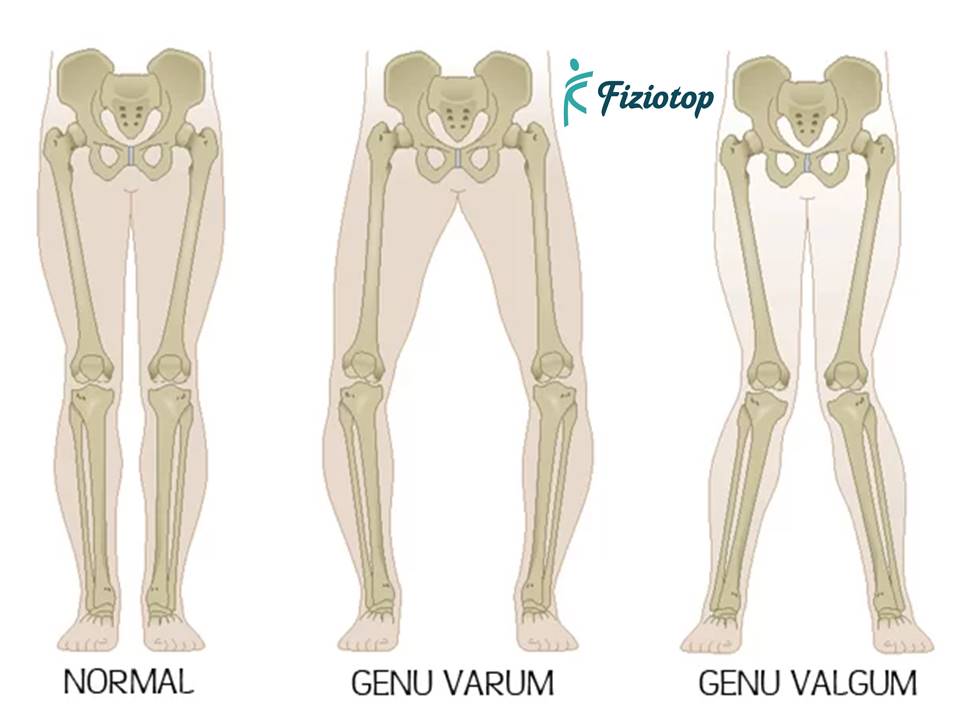Genu Varum și Genu Valgum la copii: Ghid pentru părinți - Fiziotop